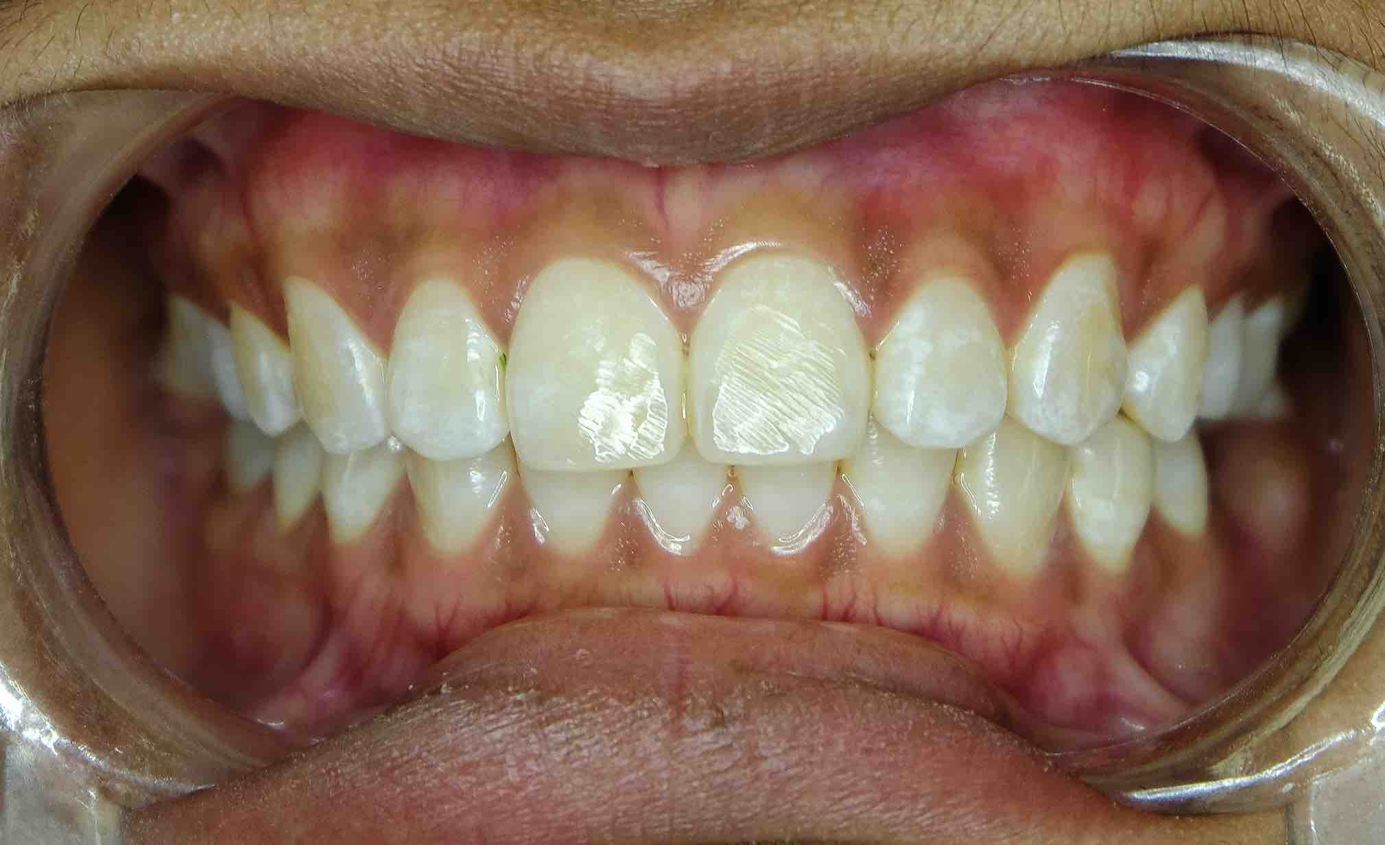  Qu Es La Fluorosis Dental Causas Y Tratamiento Vitaldent