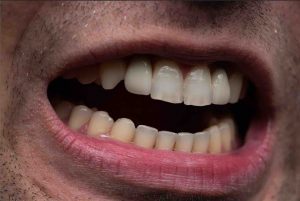 Prognatismo mandibular: qué es y cómo se puede corregir | Blog Vitaldent