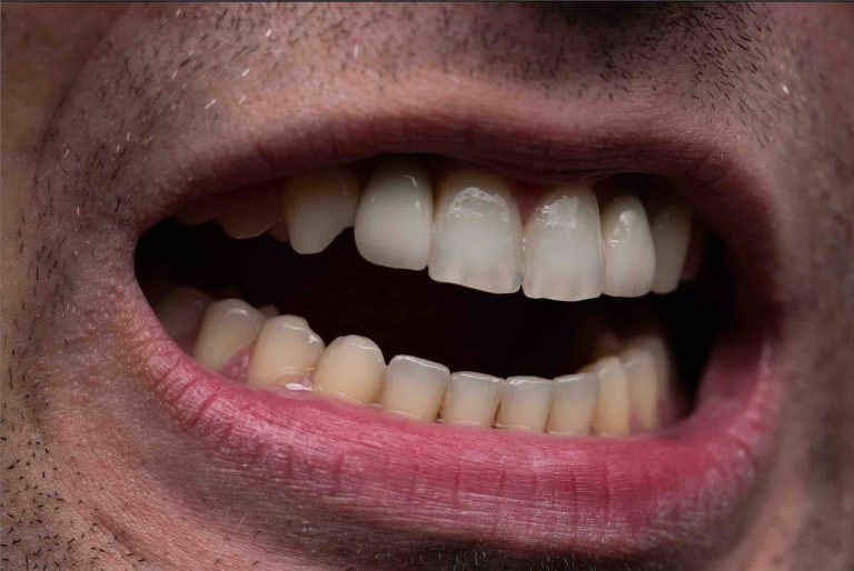 Prognatismo mandibular: qué es y cómo se puede corregir | Blog Vitaldent