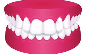 Sobremordida: ¿cuál es el tratamiento más adecuado? | Vitaldent